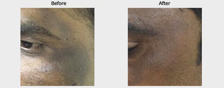 Skin Pigmentation Treatment - Get Rid Of Dark, Patchy Spots