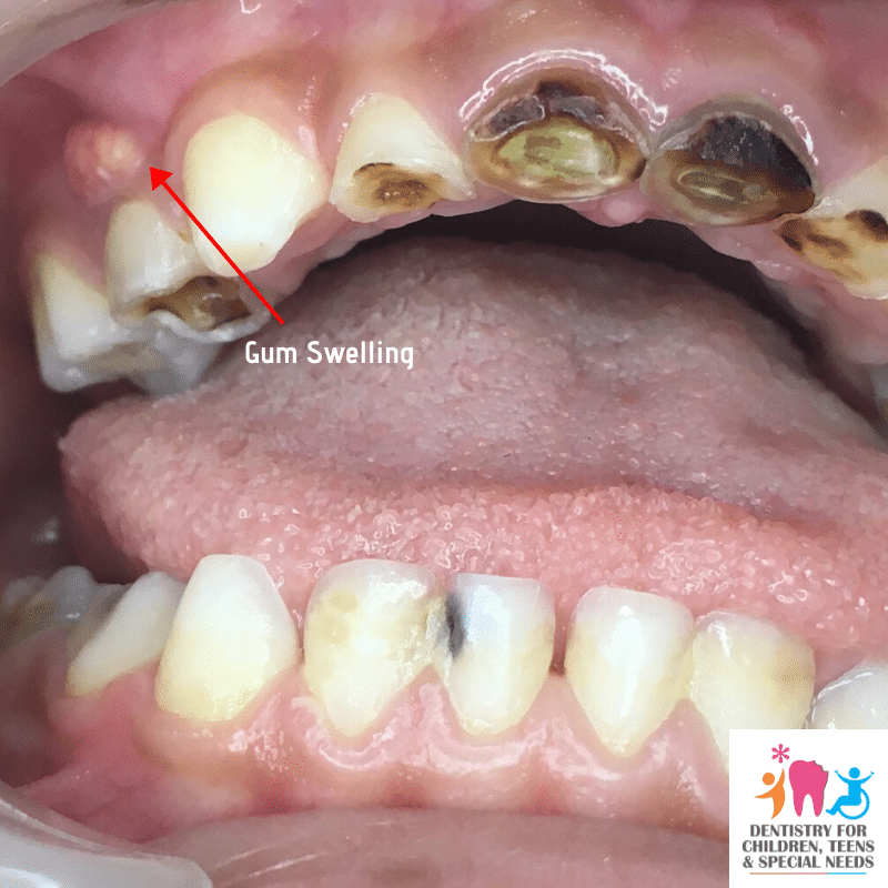 Prevent Tooth Decay in Kids With The Right Oral Care Habits