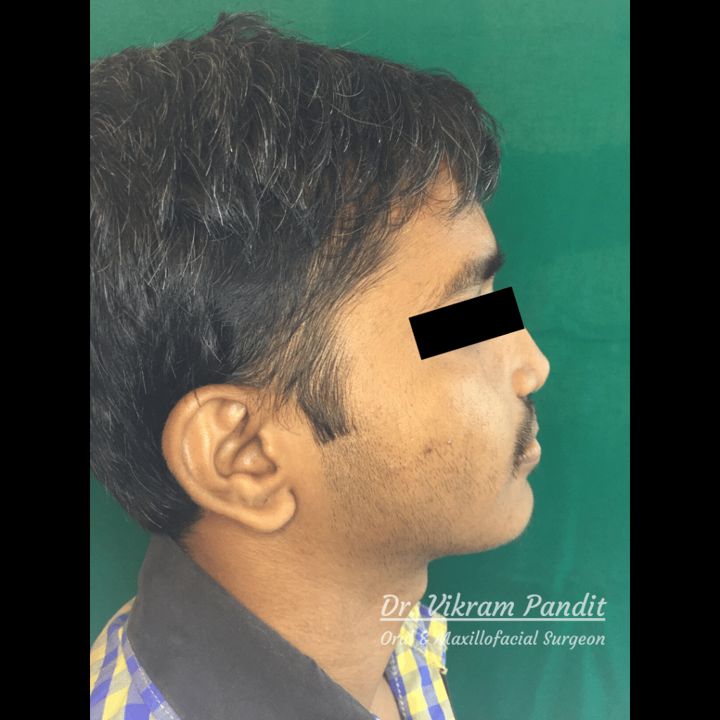Corrective Jaw Surgery at Pandit Clinic - Realign Your Jaws