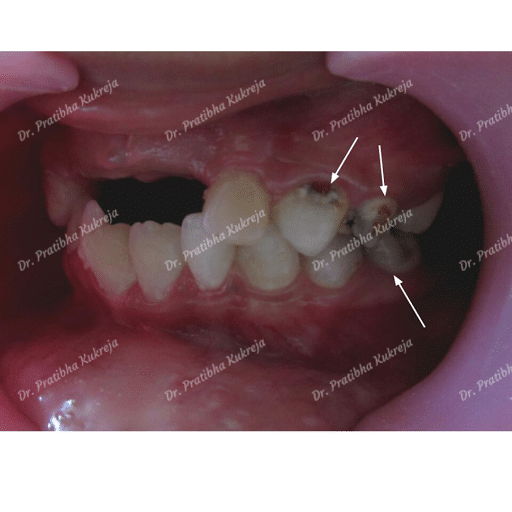 Dental Care for children on the Autism Spectrum.