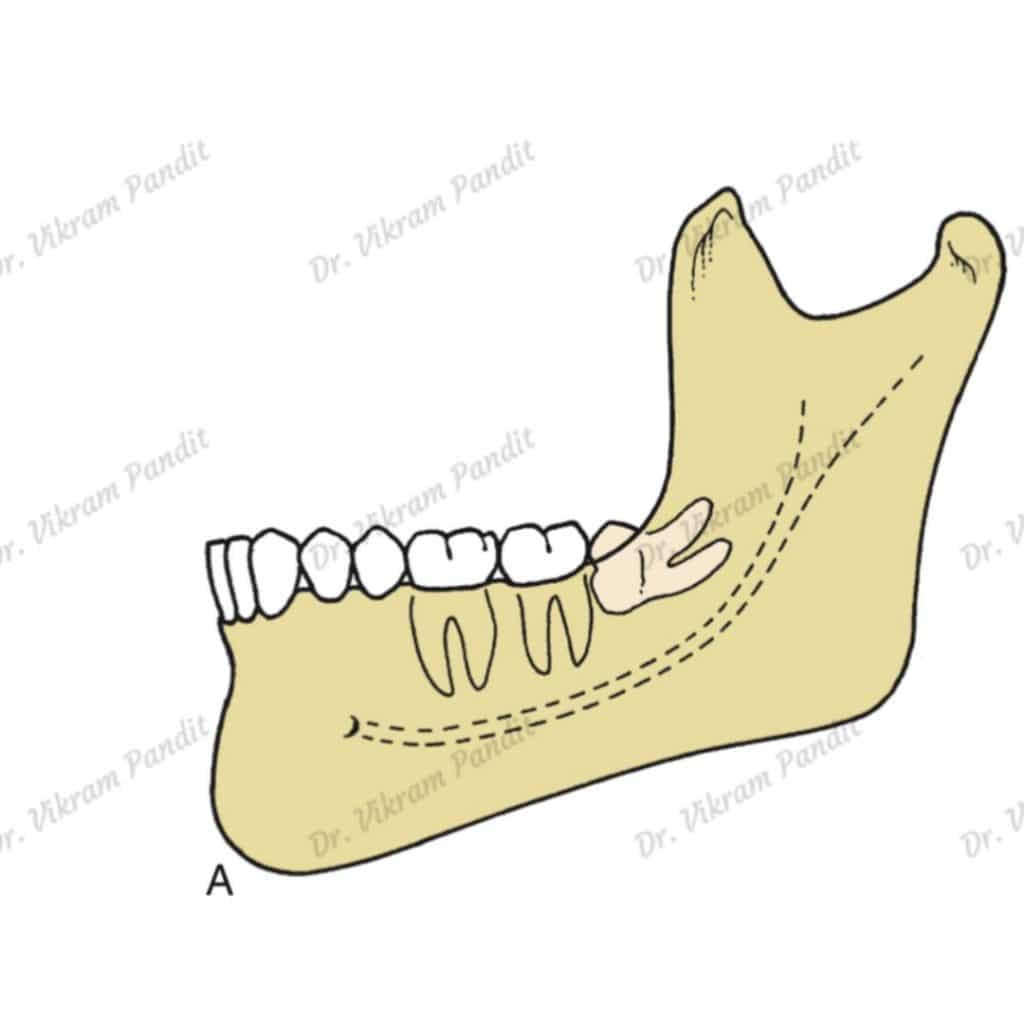Wisdom Tooth Surgery: Procedure, Recovery, Costs | Dr. Vikram Pandit