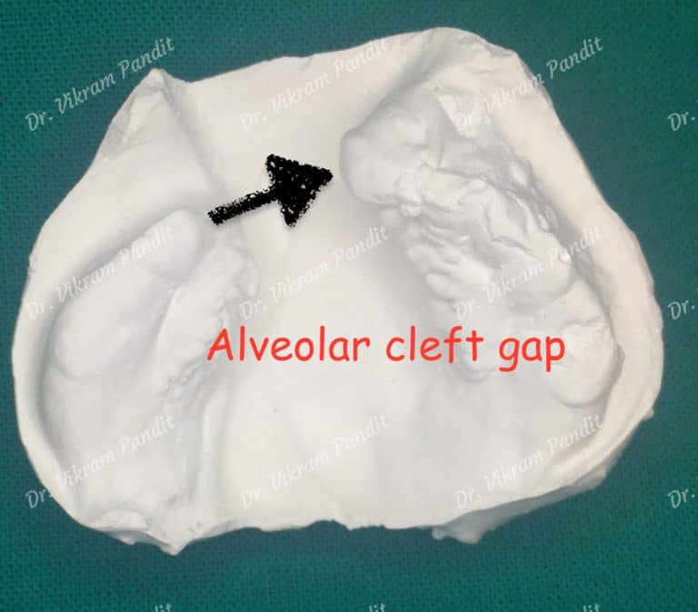 Alveolar Bone Grafting: Overview of Procedure
