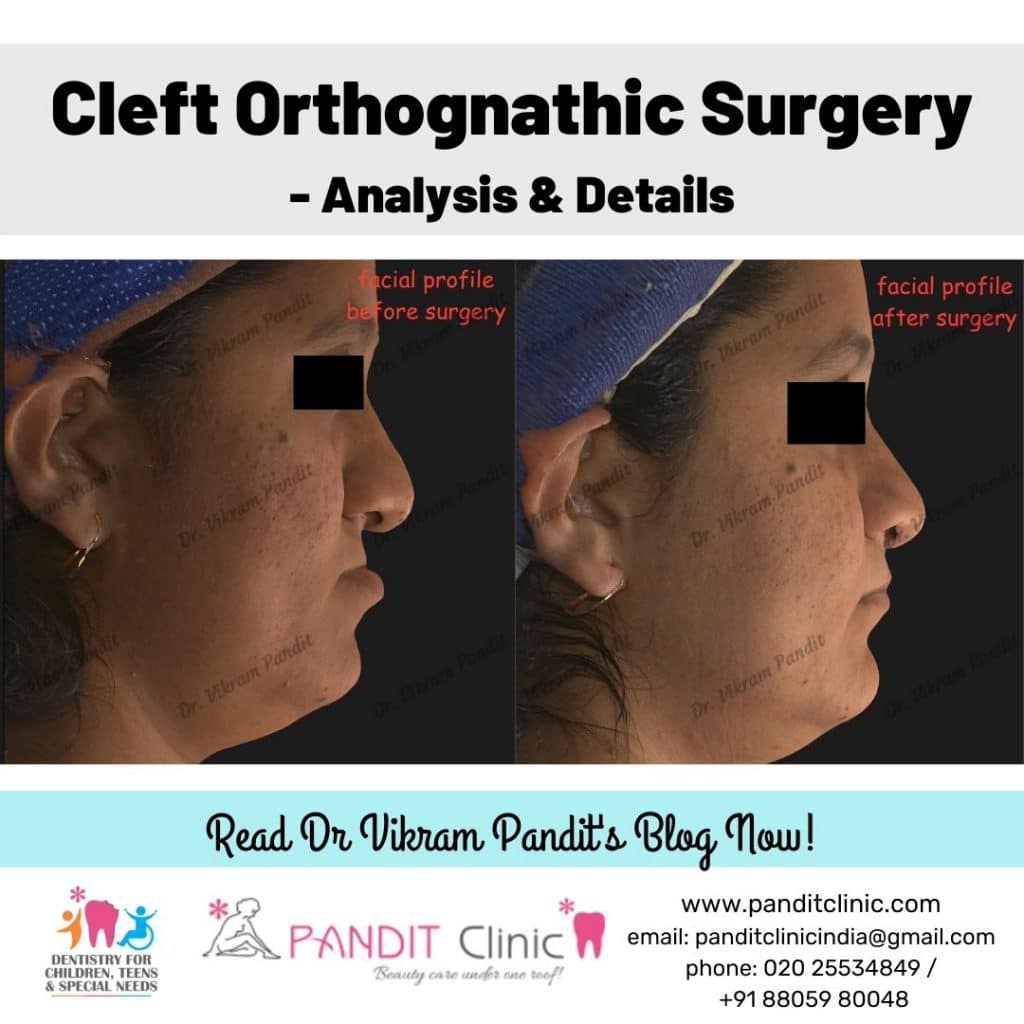 Cleft Orthognathic Surgery: Analysis & Details