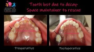 Tooth Extraction in Children - Causes, Preparation, Procedure